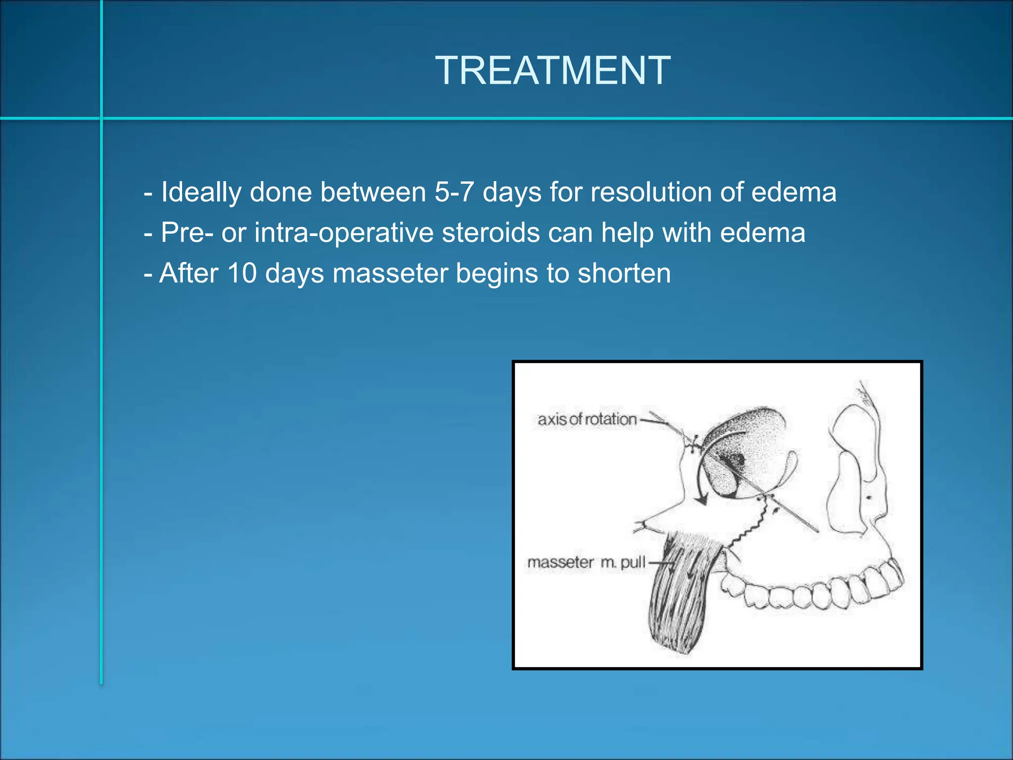 ZMC Fractures - Copy.ppt zygomatico maxillary fracture | PPT