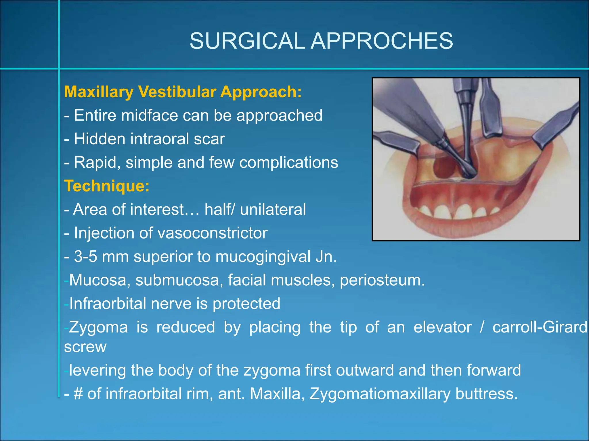 ZMC Fractures - Copy.ppt zygomatico maxillary fracture | PPT