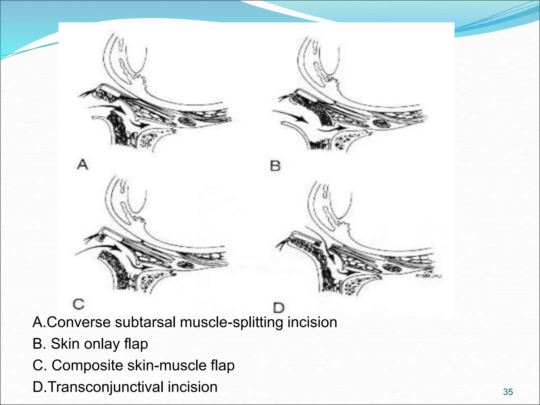 ZMC Fractures - Copy.ppt zygomatico maxillary fracture | PPT