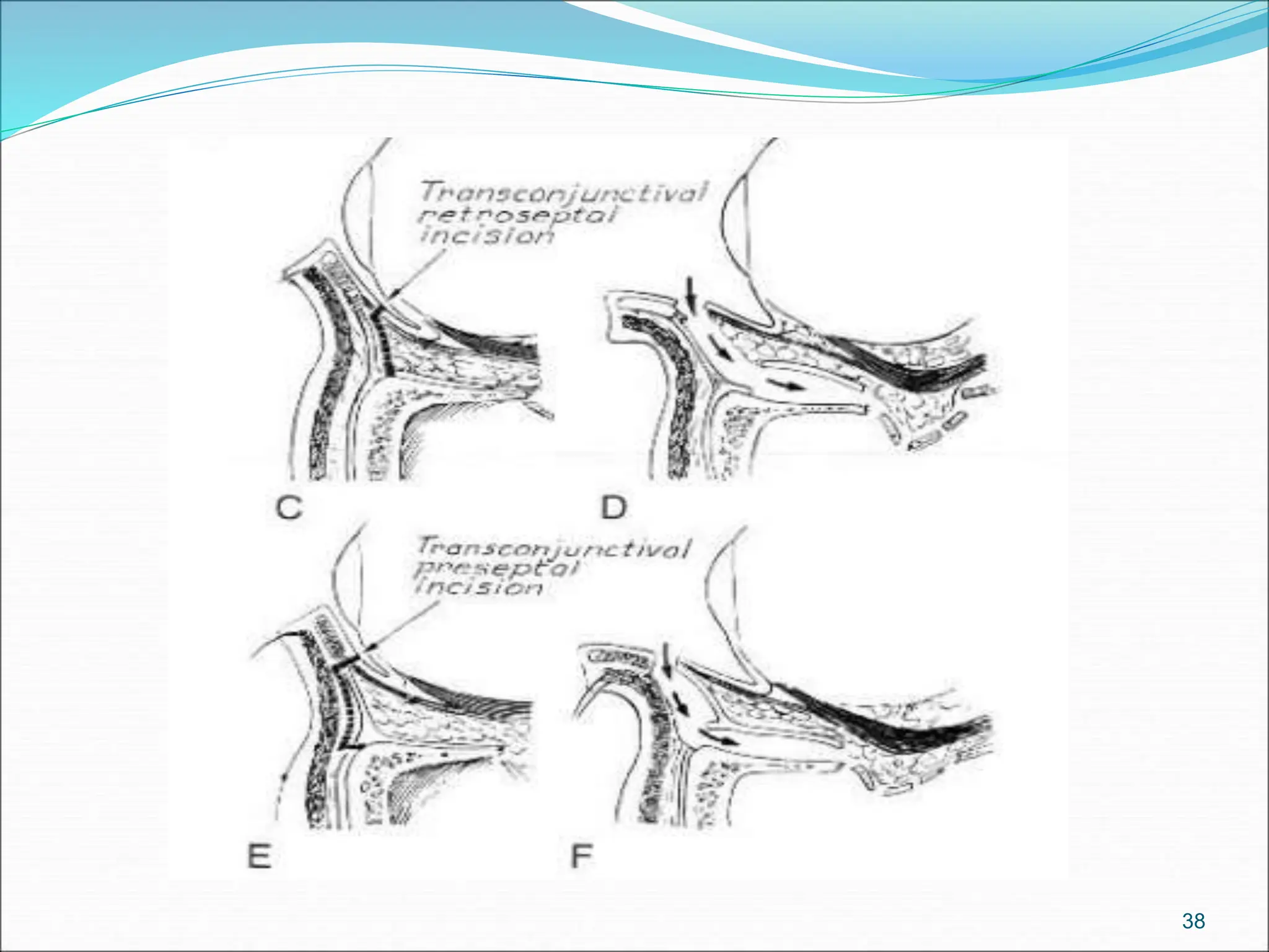 ZMC Fractures - Copy.ppt zygomatico maxillary fracture | PPT