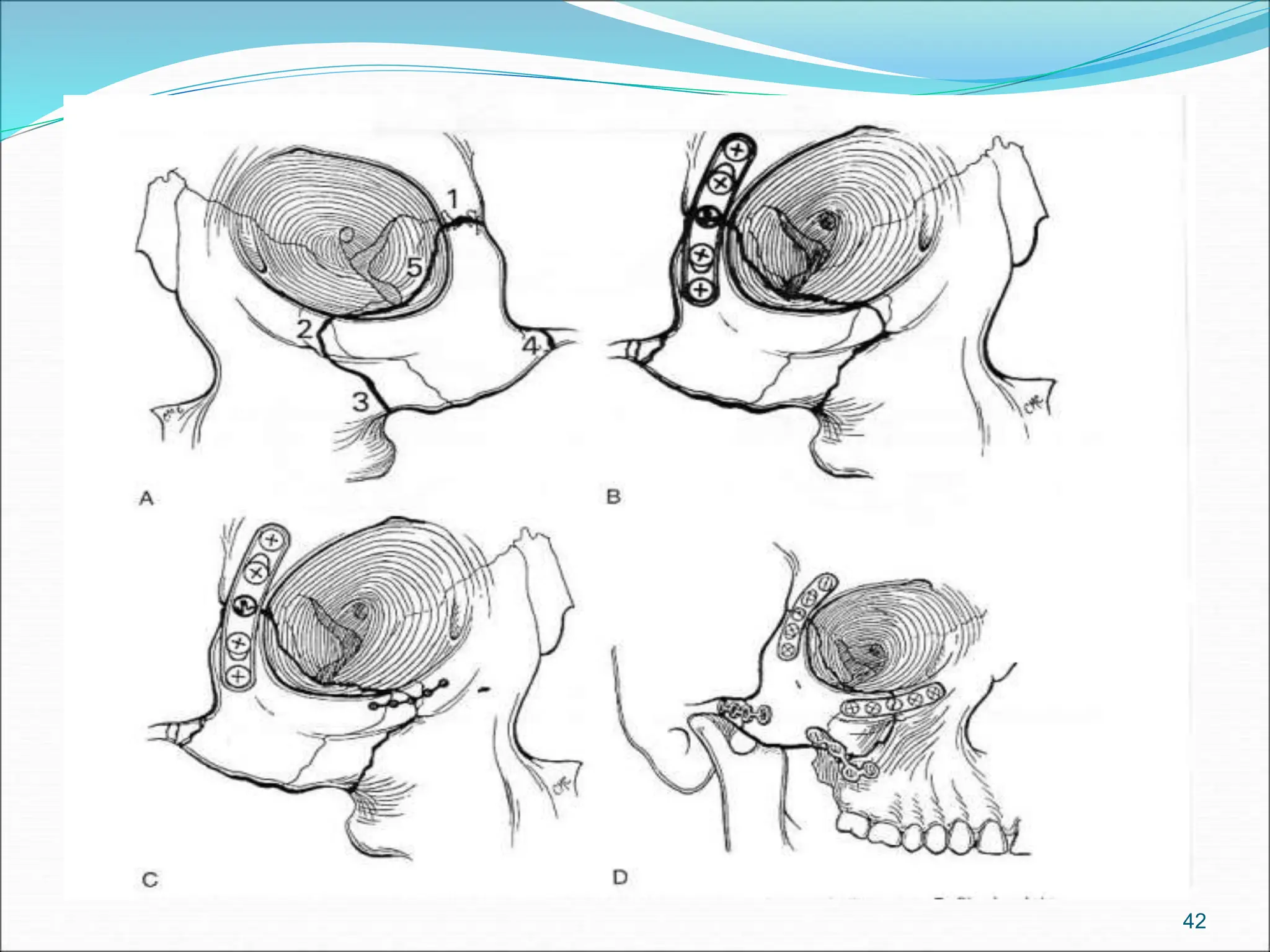 ZMC Fractures - Copy.ppt zygomatico maxillary fracture | PPT