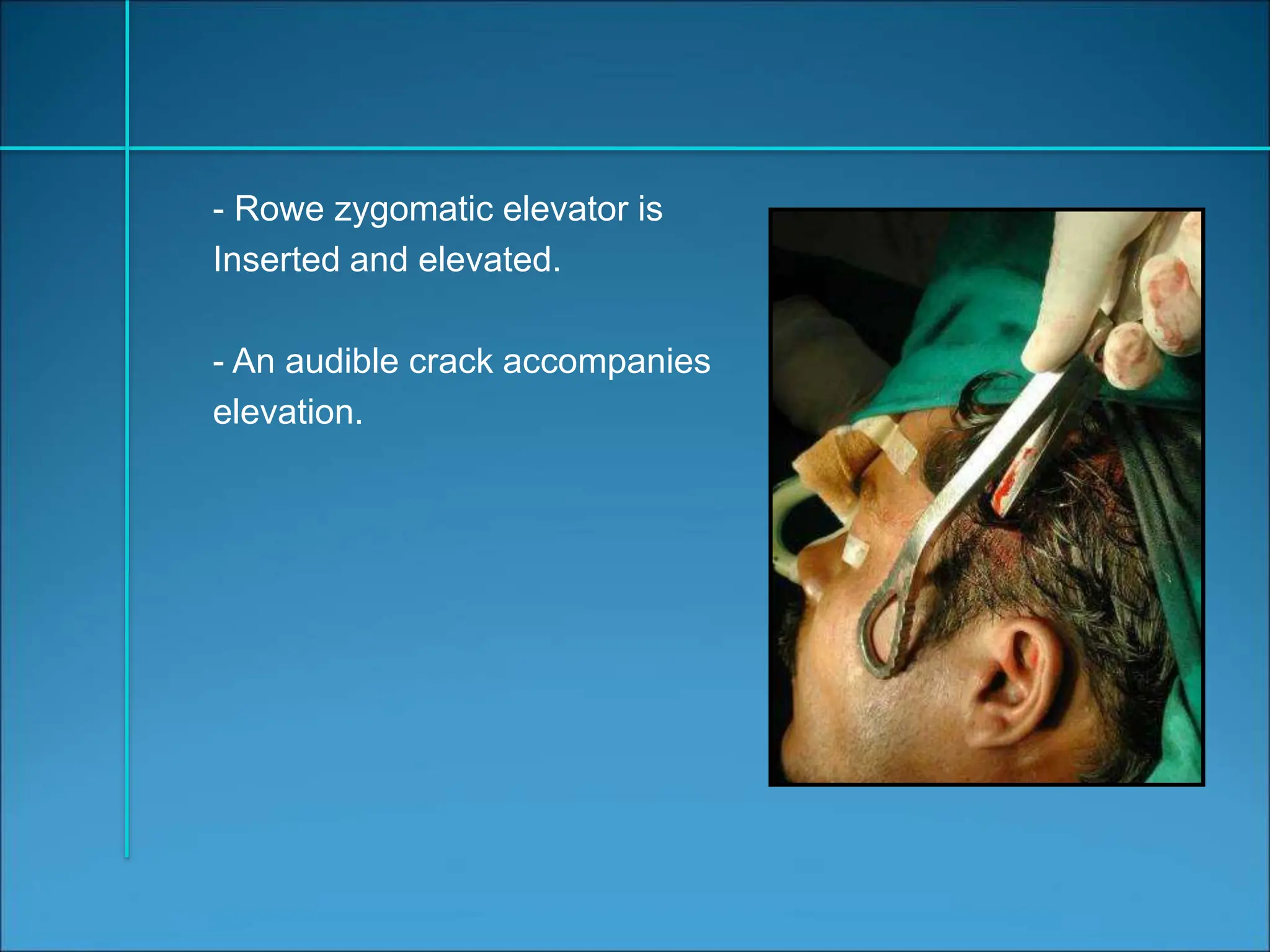 ZMC Fractures - Copy.ppt zygomatico maxillary fracture | PPT