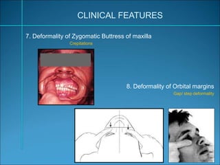 ZMC Fractures - Copy.ppt zygomatico maxillary fracture | PPT