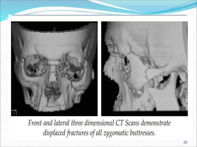 Zmc Fractures Copyppt Zygomatico Maxillary Fracture Ppt