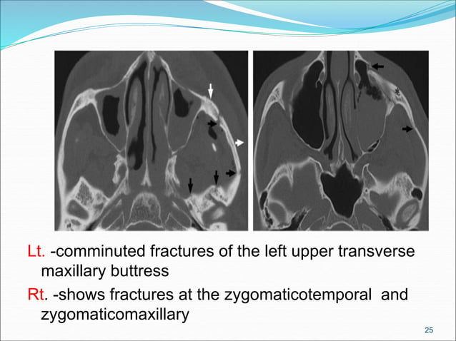 ZMC Fractures - Copy.ppt zygomatico maxillary fracture | PPT