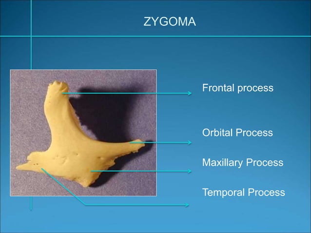 ZMC Fractures - Copy.ppt zygomatico maxillary fracture | PPT