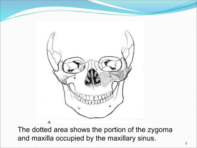 ZMC Fractures - Copy.ppt zygomatico maxillary fracture | PPT