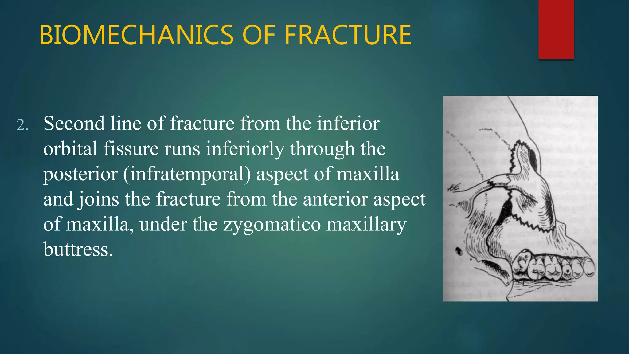 Zmc fractures part 1 | PPT