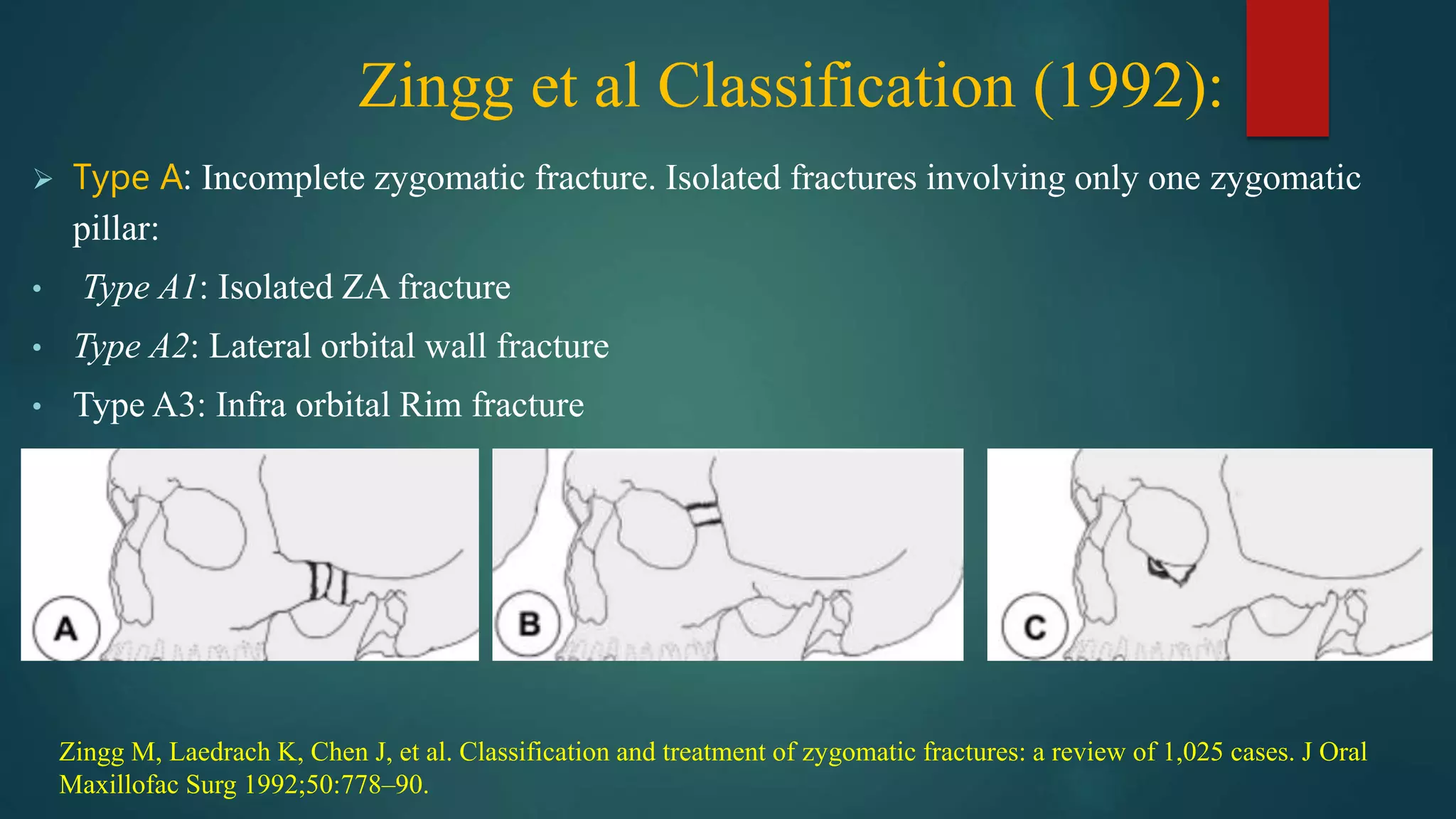Zmc fractures part 1 | PPTX