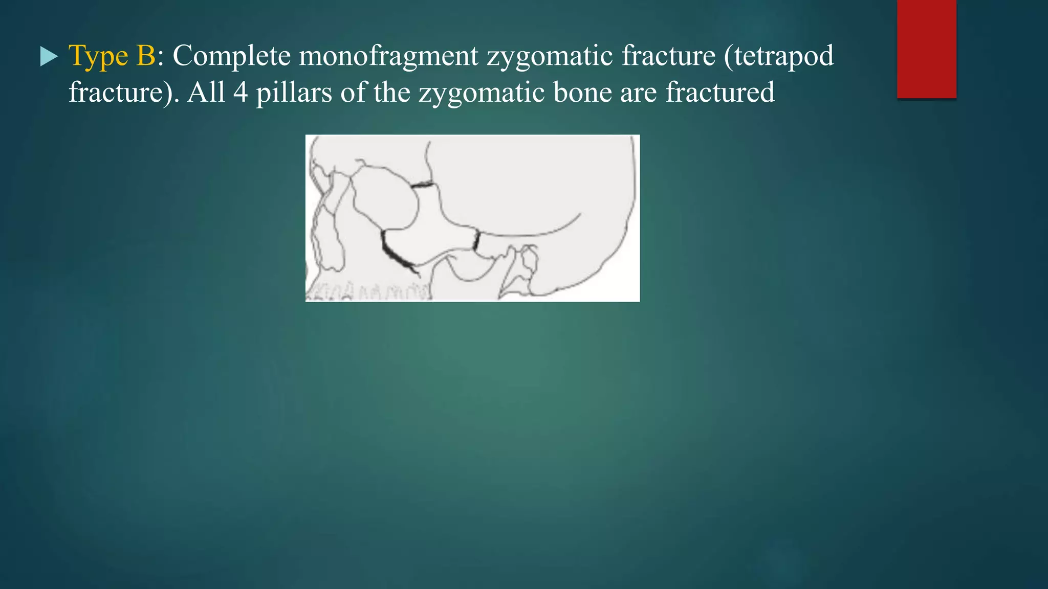 Zmc fractures part 1 | PPTX