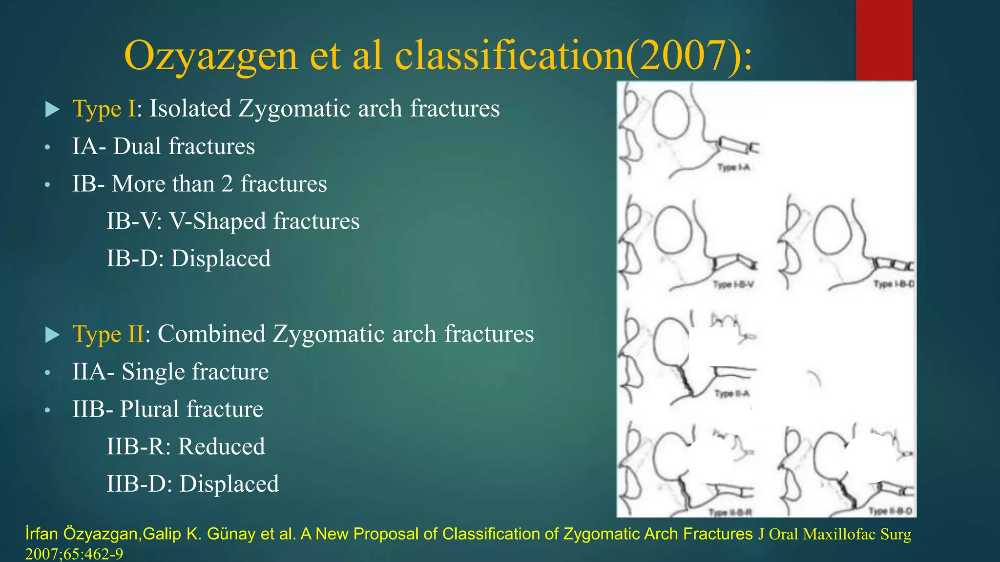 Zmc fractures part 1 | PPTX