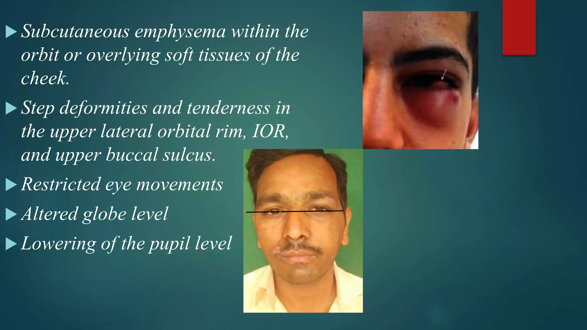 Zmc fractures part 1 | PPTX