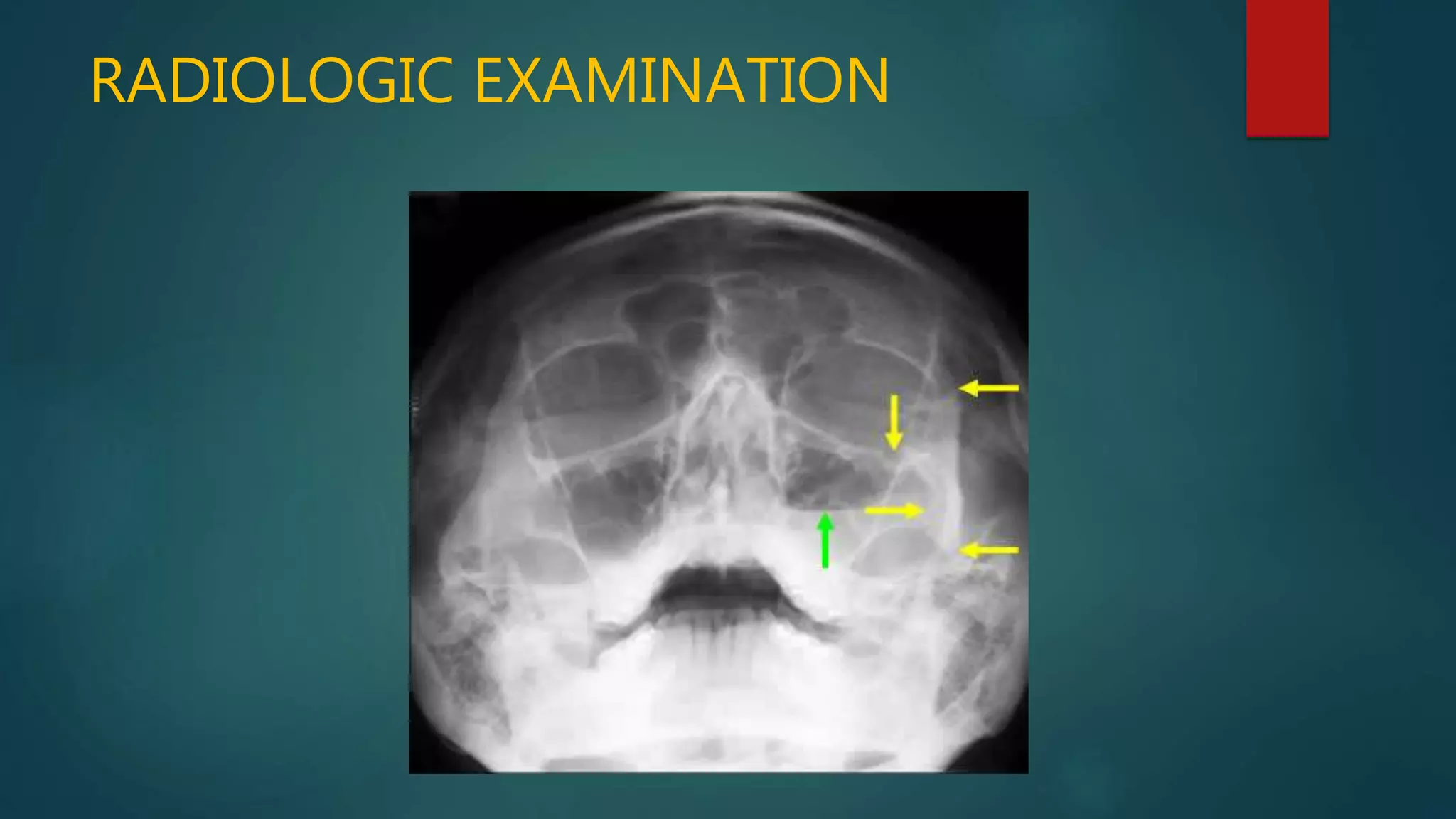 Zmc fractures part 1 | PPTX