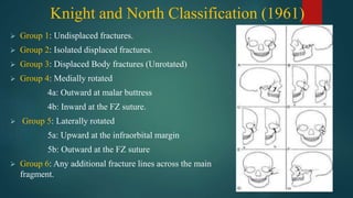 Zmc fractures part 1 | PPTX