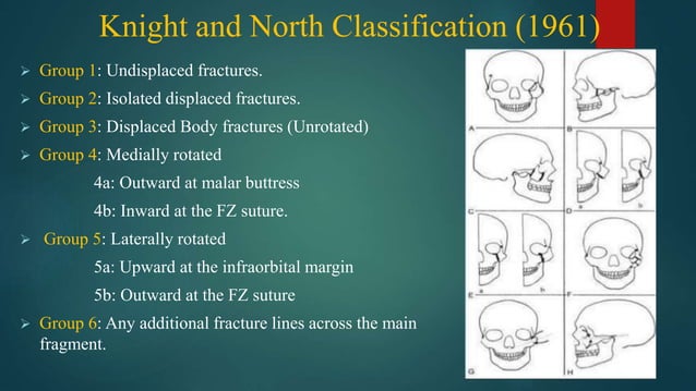 Zmc fractures part 1 | PPTX