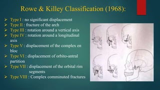 Zmc fractures part 1 | PPTX