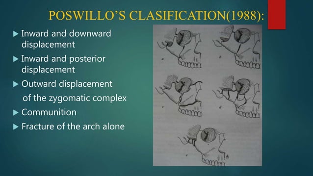 Zmc fractures part 1 | PPTX