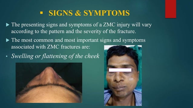 Zmc fractures part 1 | PPT