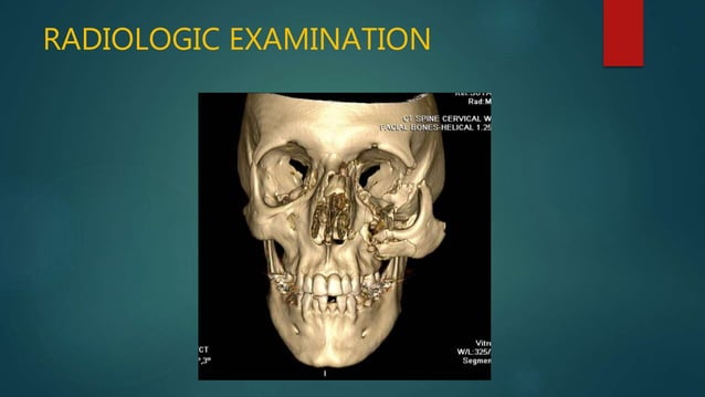 Zmc fractures part 1 | PPT