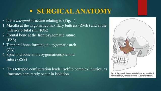 Zmc fractures part 1 | PPT