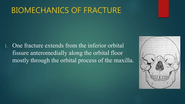 Zmc fractures part 1 | PPTX