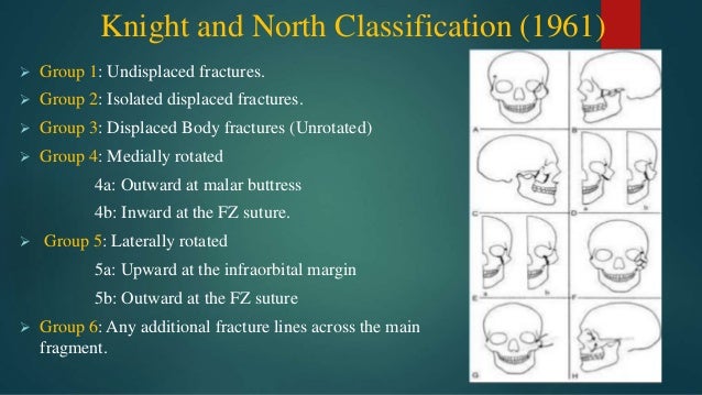 Zmc fractures part 1