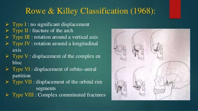 Zmc Fractures Part 1
