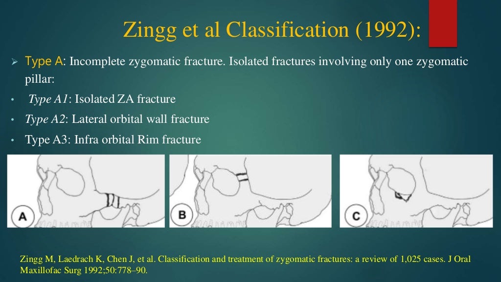 Zmc fractures part 1