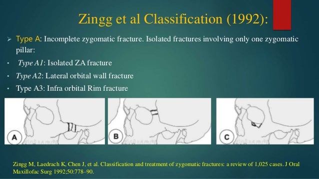 Zmc Fractures Part 1