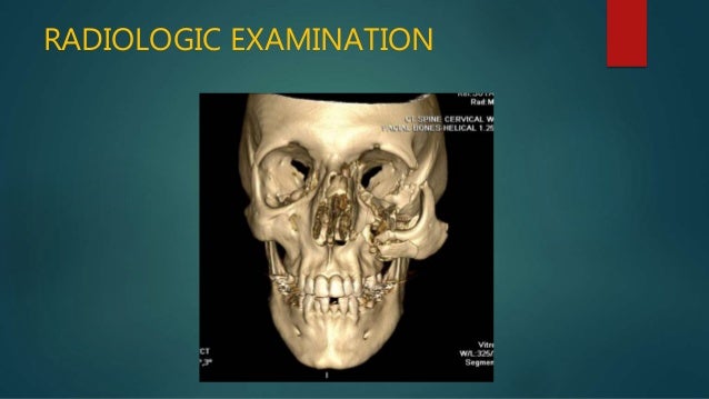 Zmc Fractures Part 1