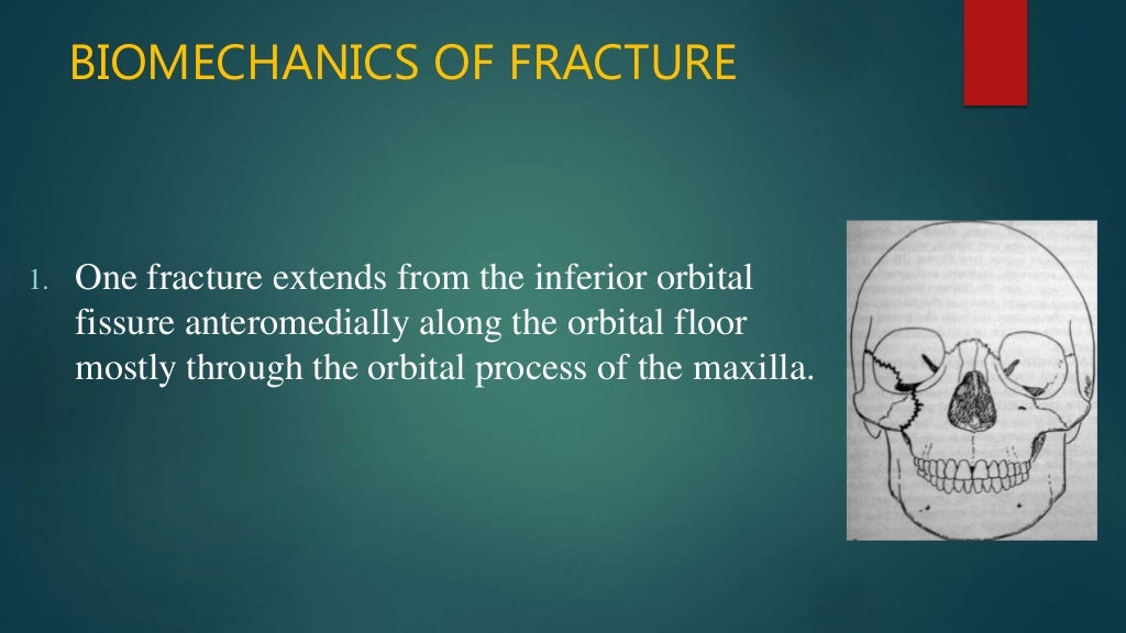 Zmc Fractures Part 1