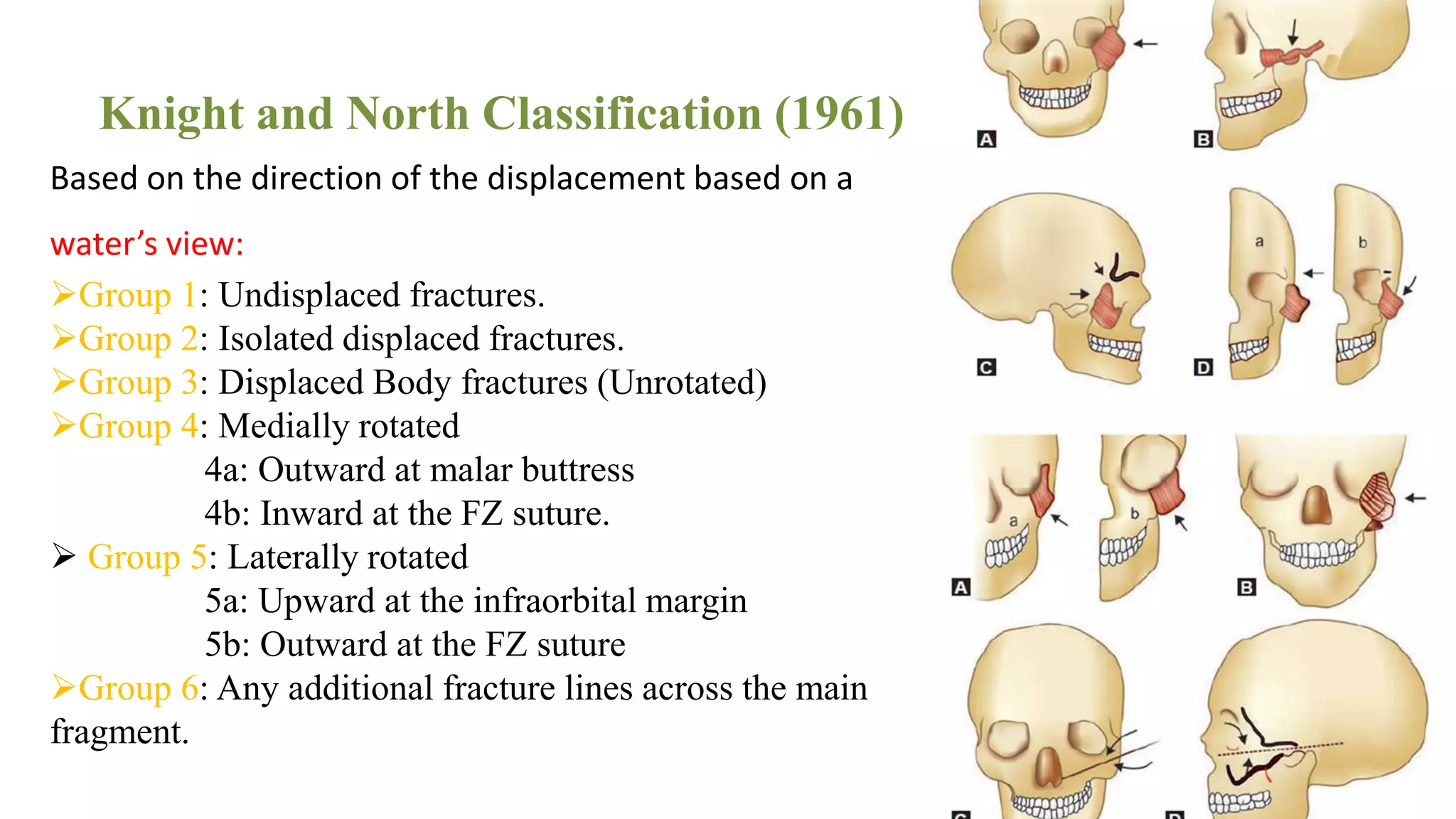 Zmc fractures and management | PPTX