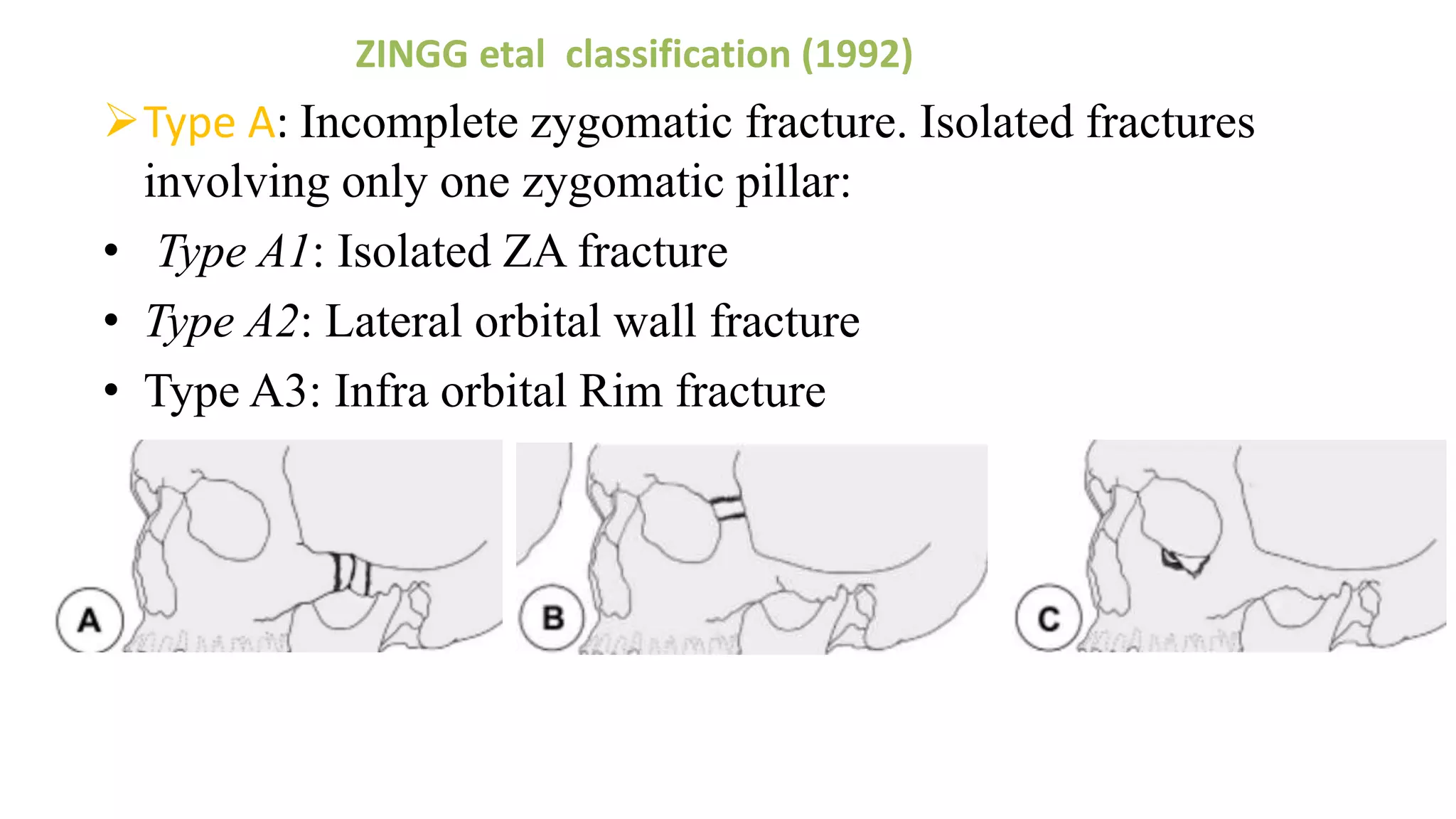 Zmc fractures and management | PPTX