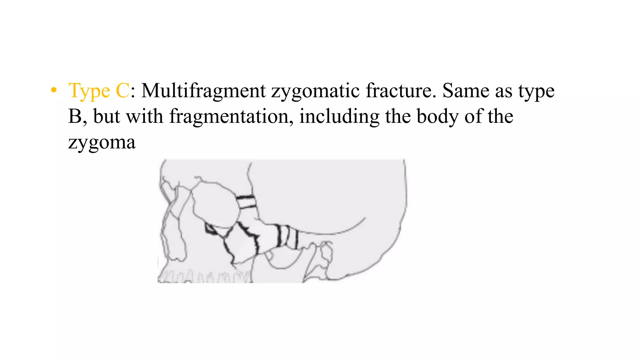Zmc fractures and management | PPTX