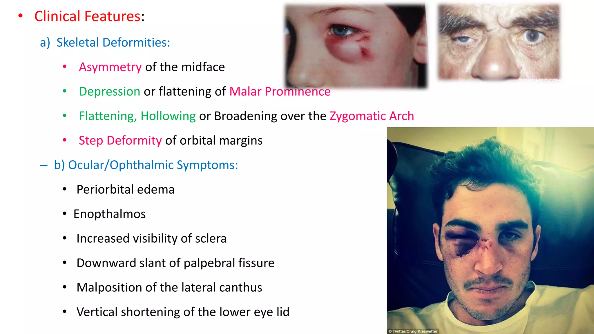 Zmc fractures and management | PPTX