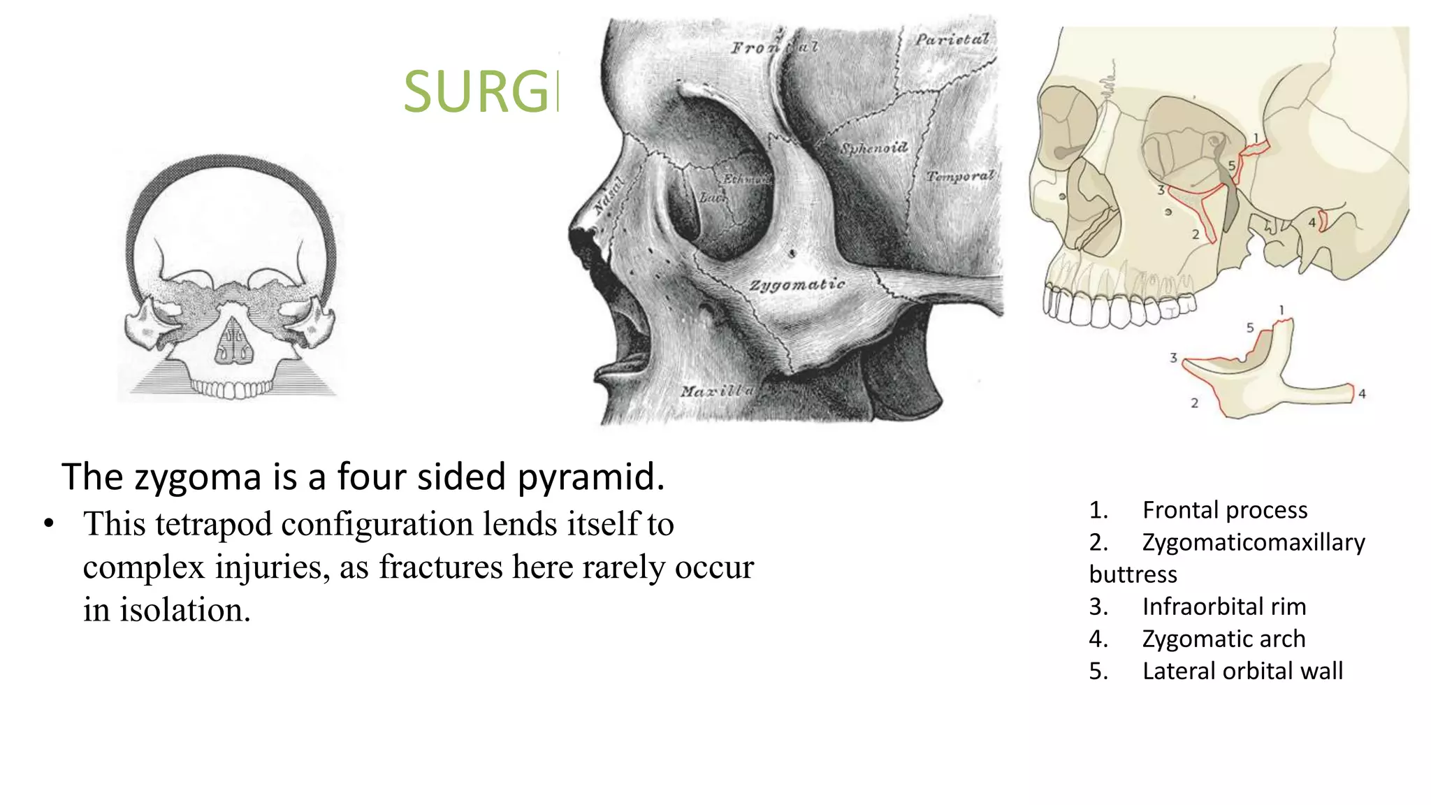 Zmc fractures and management | PPTX