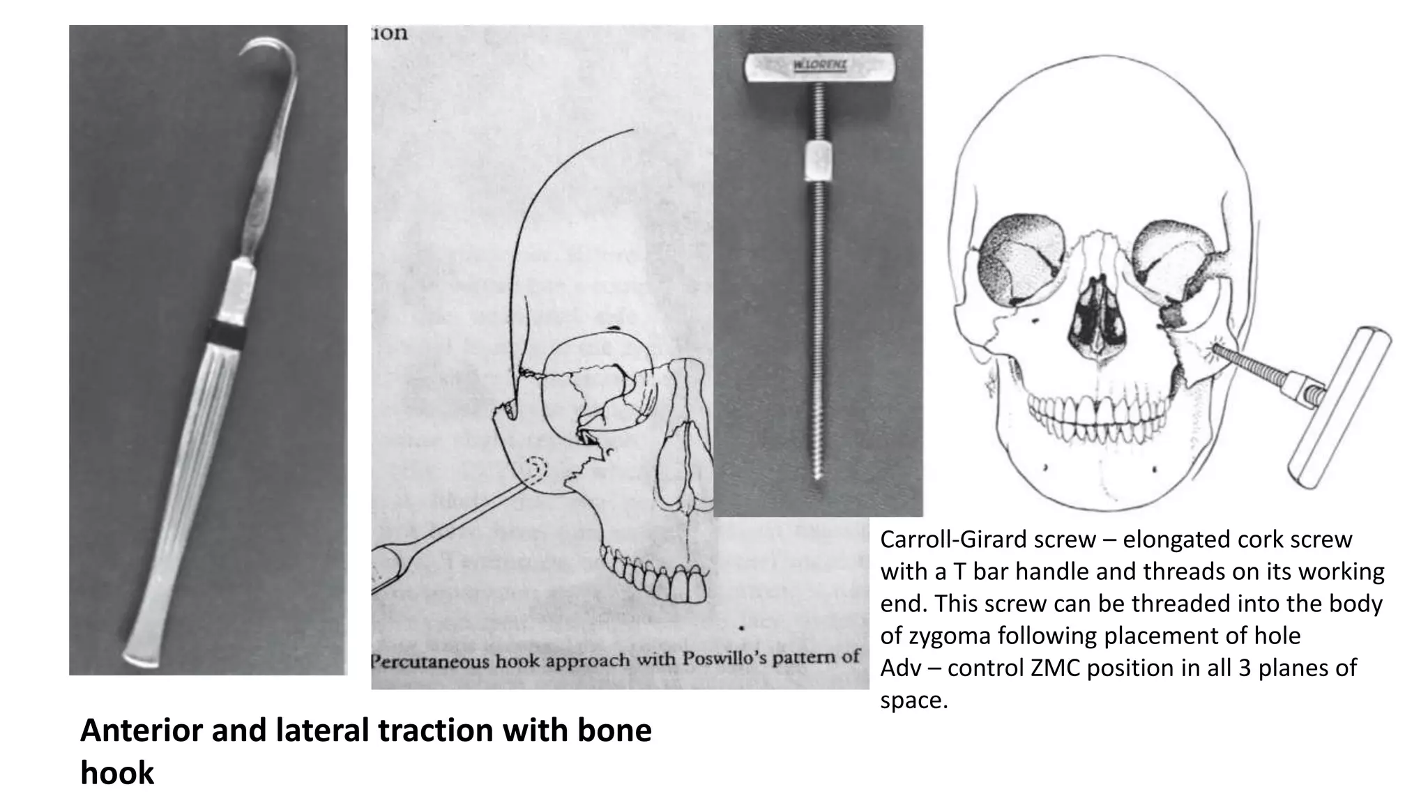 Zmc Fractures And Management Ppt