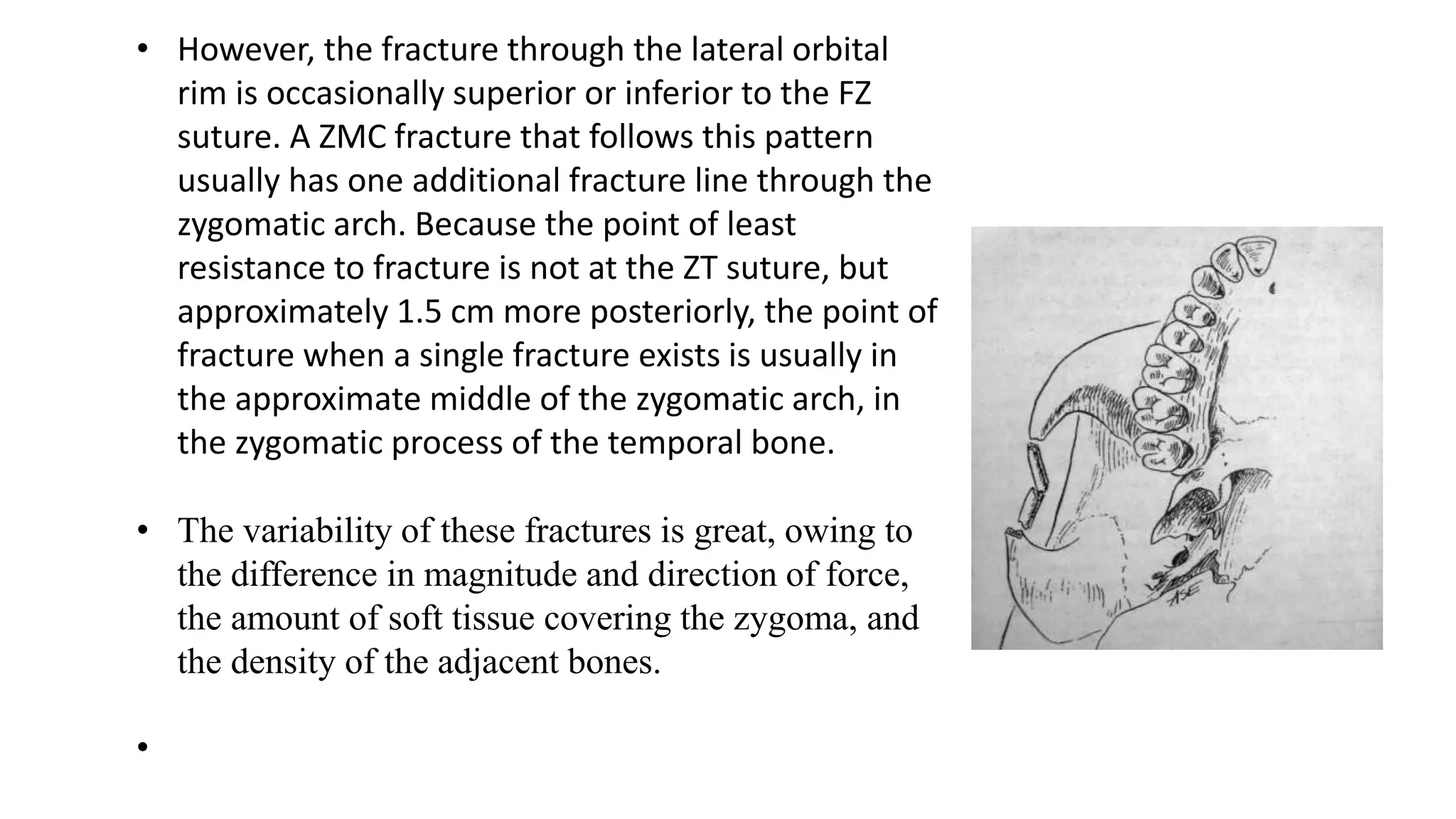 Zmc fractures and management | PPTX