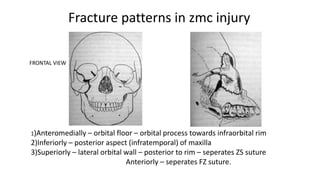 Zmc fractures and management | PPTX
