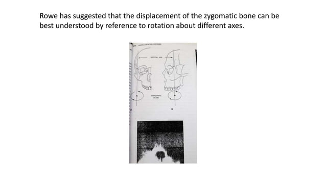 Zmc Fractures And Management