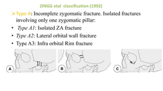 Zmc fractures and management | PPT