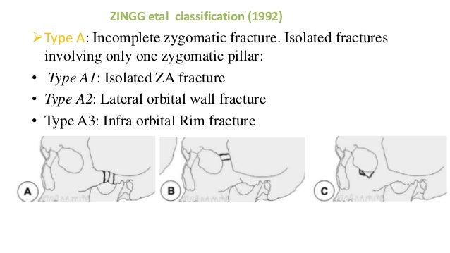 Zmc fractures and management
