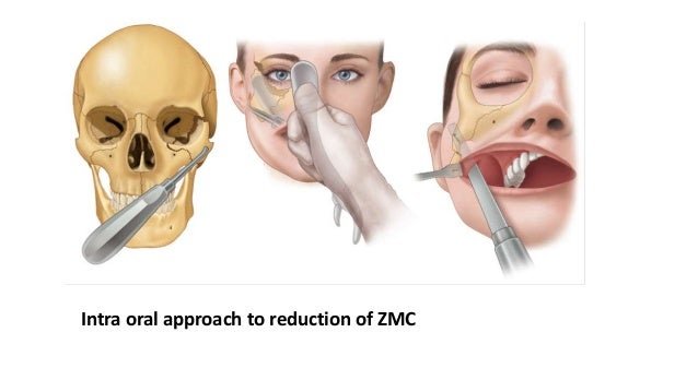 Zmc fractures and management