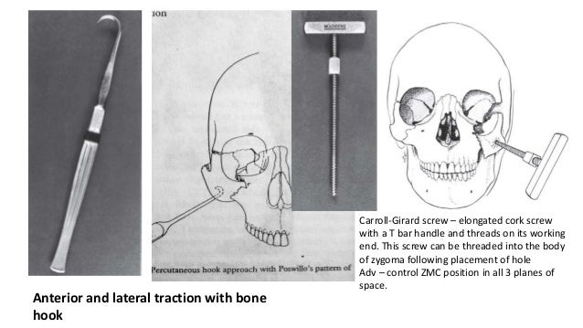 Zmc fractures and management