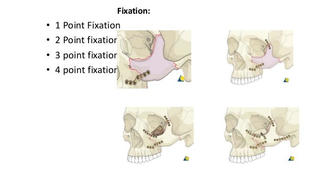 Zmc fractures and management