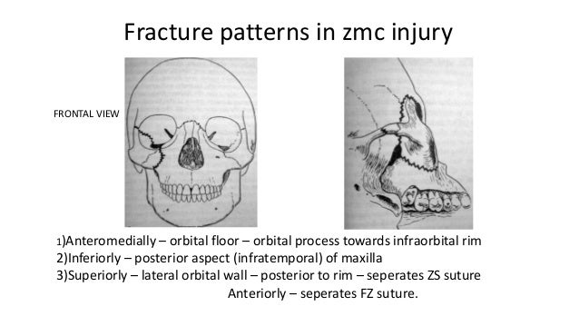 Zmc fractures and management