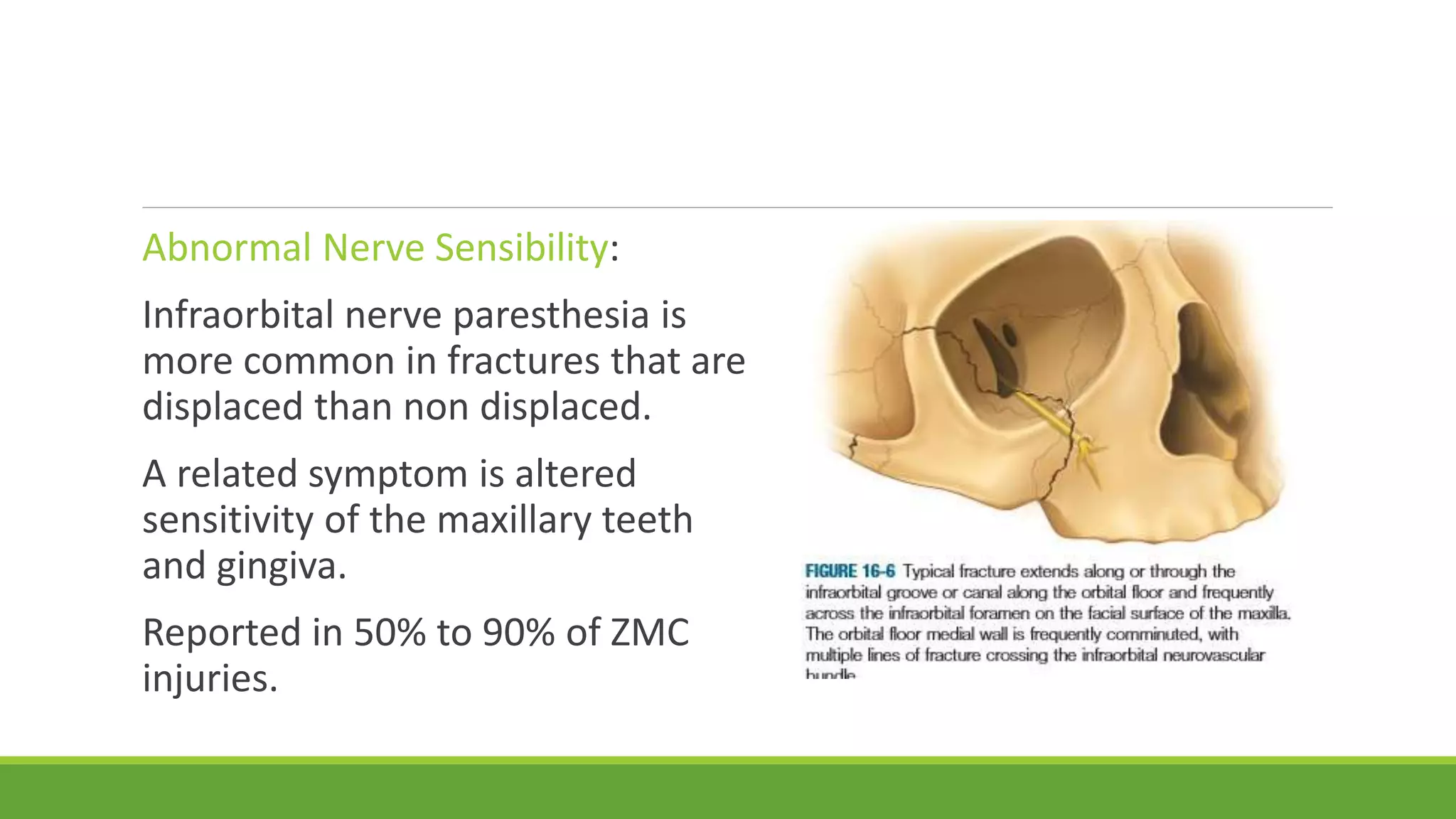 ZMC Fracture | PPTX