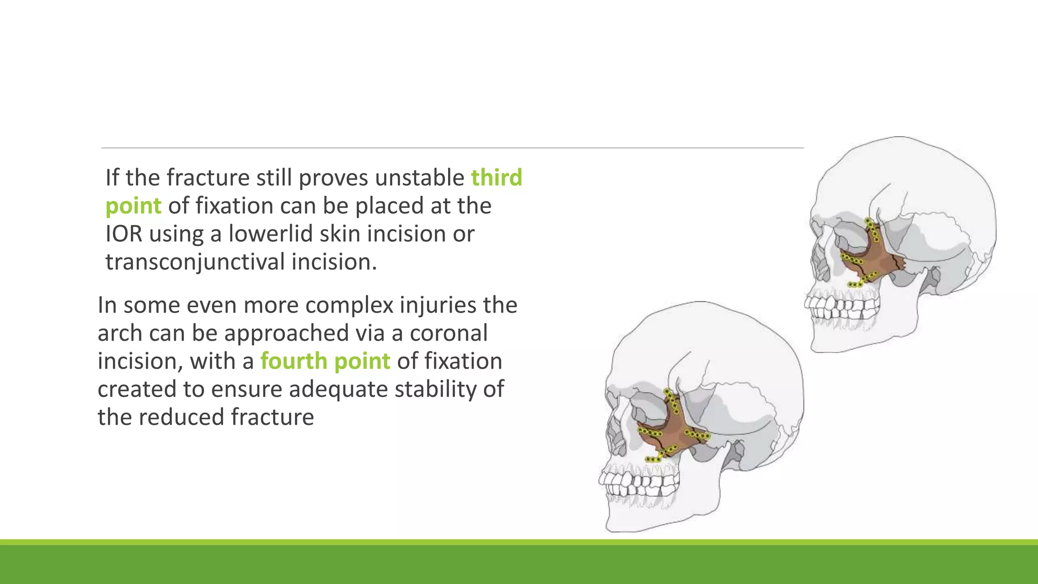 ZMC Fracture | PPTX