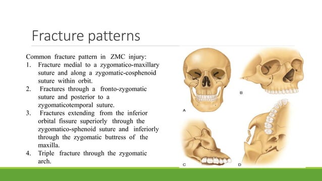ZMC Fracture | PPTX