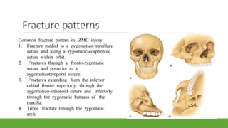 ZMC Fracture | PPT